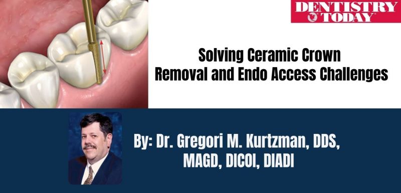 Solving Ceramic Crown Removal and Endo Access Challenges - Emerginnova